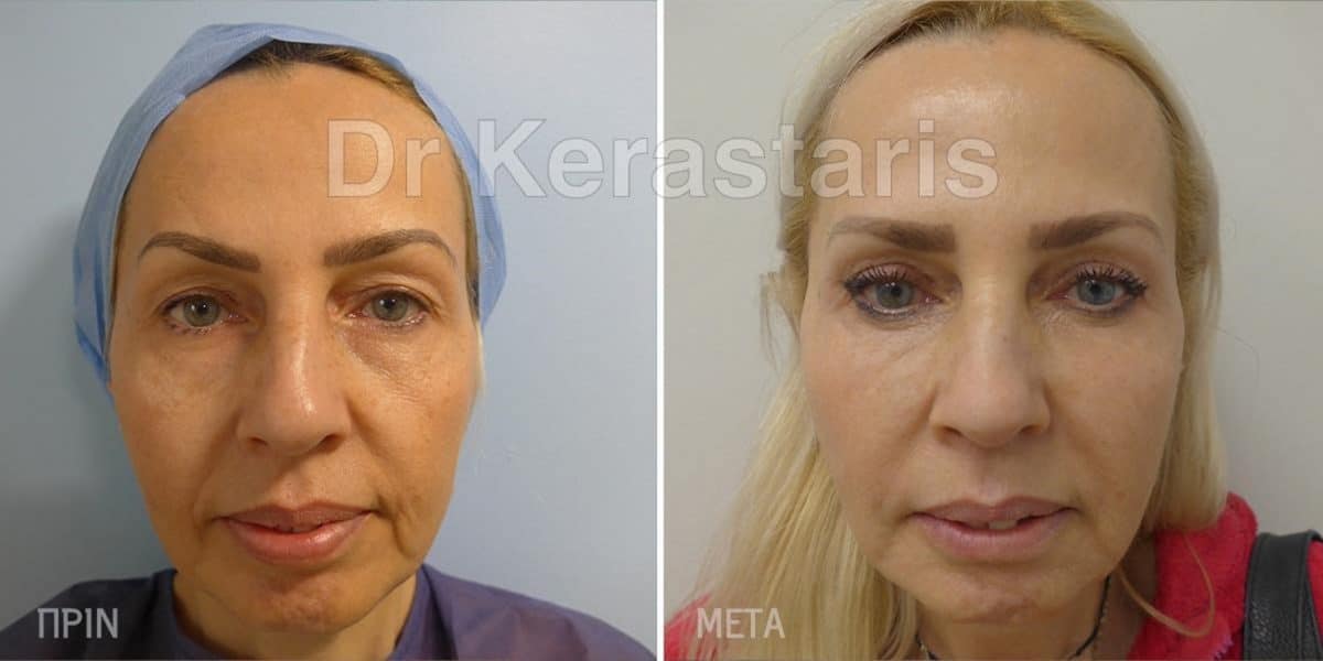 Βλεφαροπλαστική Φωτογραφίες - 3 περιστατικά ανανέωσης!
